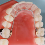 Types of Appliances - Brooklyn NY | Hanson Place Orthodontics