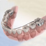 Types of Appliances - Brooklyn NY | Hanson Place Orthodontics