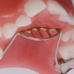 Types of Appliances - Brooklyn NY | Hanson Place Orthodontics