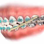 Types of Appliances - Brooklyn NY | Hanson Place Orthodontics